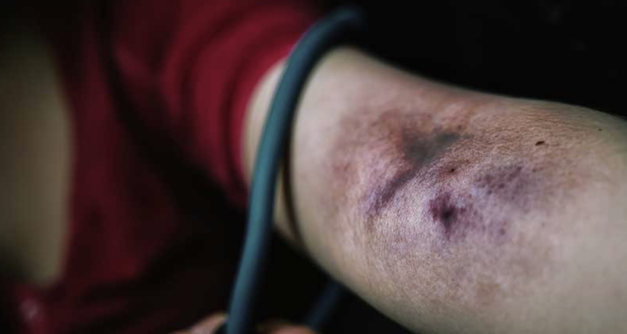 What Heroin does to Human Pupils? | Compassion Behavioral Health